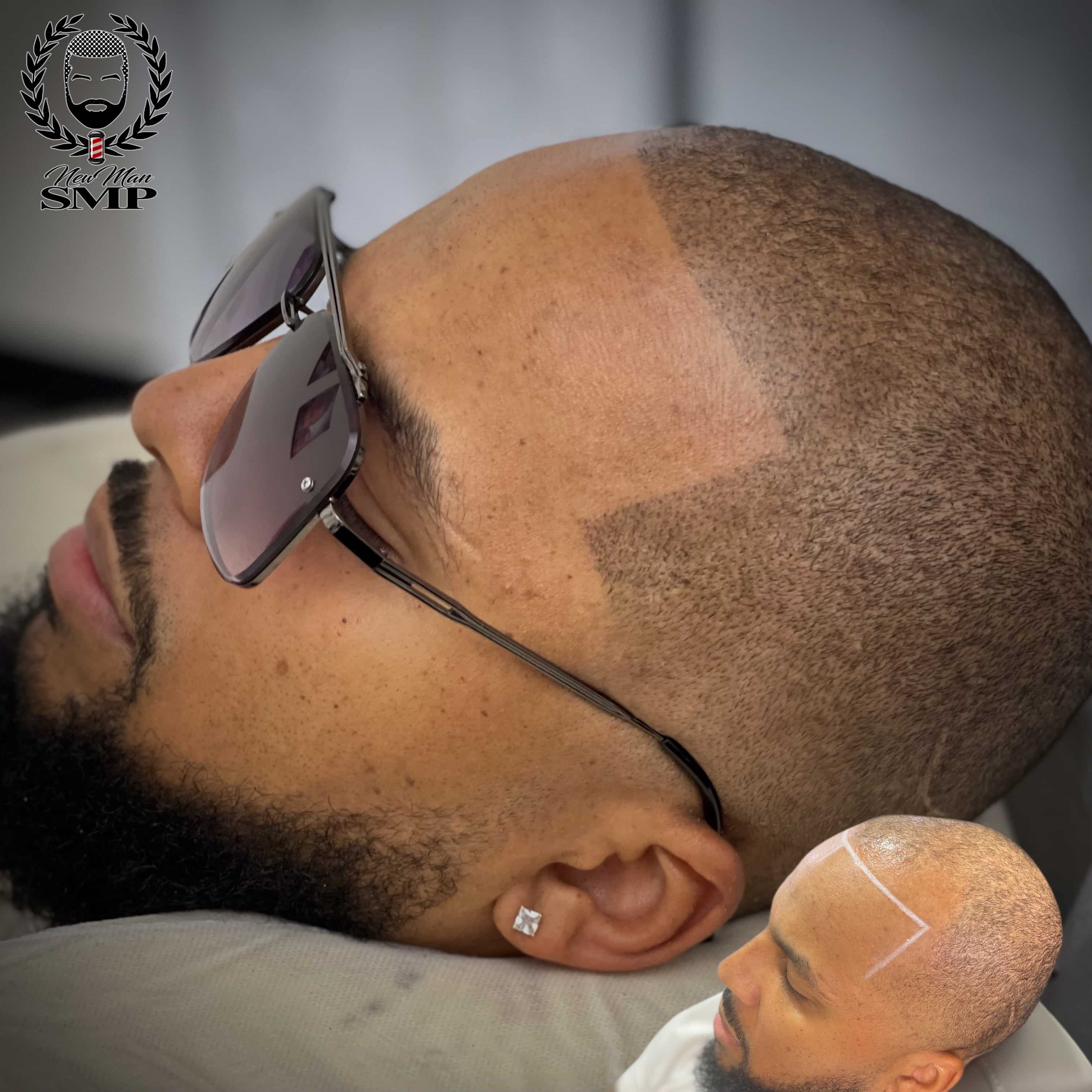 Gallery Photos of Scalp Micropigmentation by New Man SMP in Stonecrest, GA